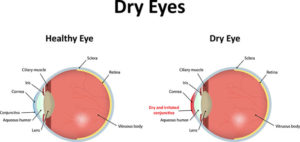 Dry Eye Treatment Jacksonville | Dry Eyes Jacksonville | Office Park Eye